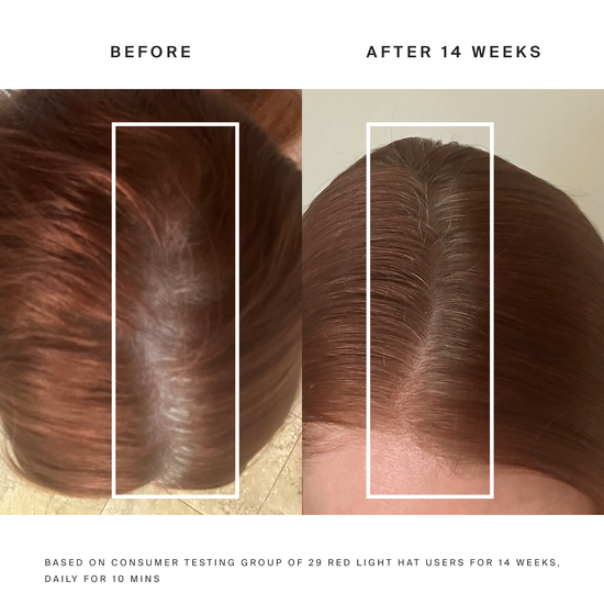 Red Light Therapy Hat | HigherDOSE